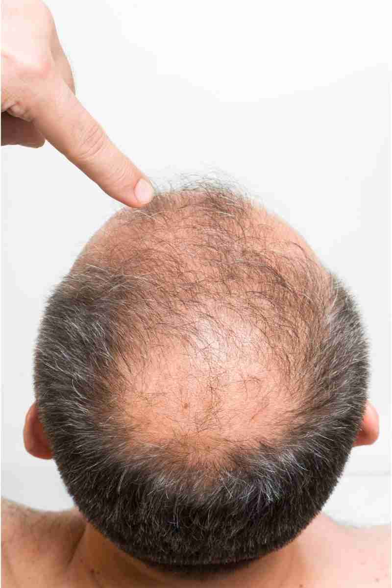 Minoxidil oral. A cura para a calvice? - Dra. Alessandra Drummond