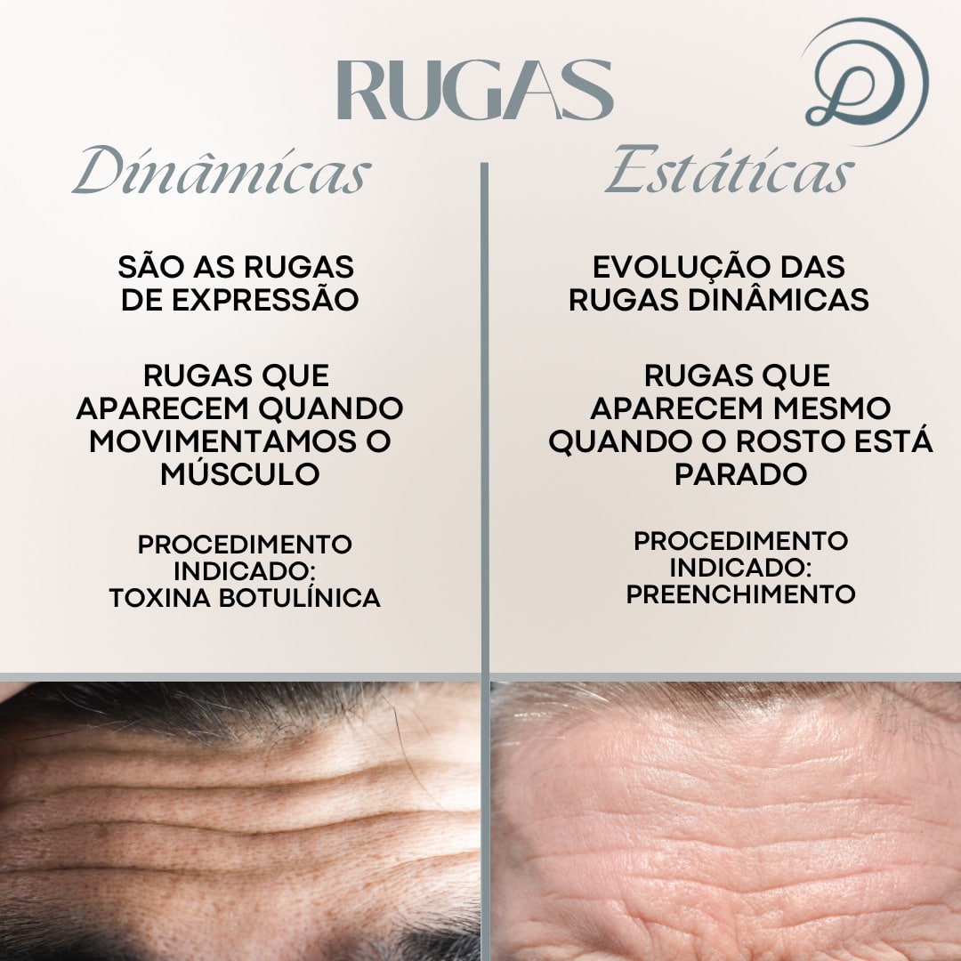 Botox na Estética: Reduzindo Rugas e Elevando a Autoestima - Dra ...